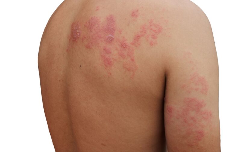 Shingles Scars